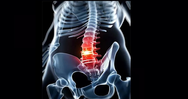 Discopatía lumbar entre principales causas de discapacidad | La Verdad ...